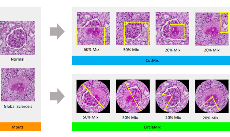 Improve Global Glomerulosclerosis Classification with Imbalanced Data ...