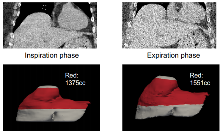 Measure Partial Liver Volumetric Variations from Paired Inspiratory ...