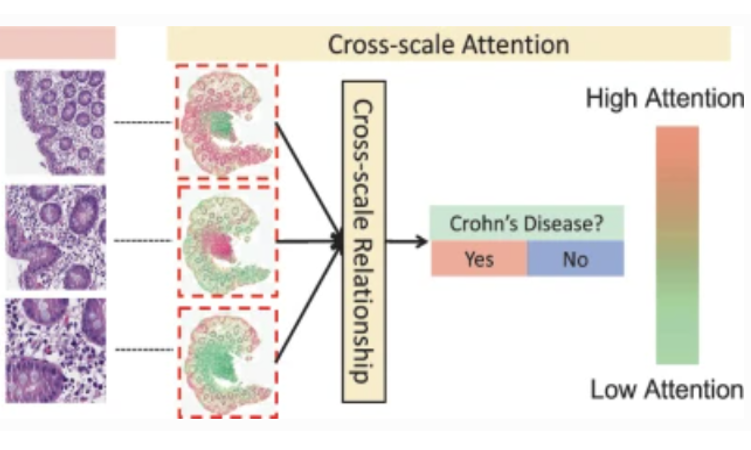 Cross Scale Attention Guided Multi Instance Learning For Crohns Disease